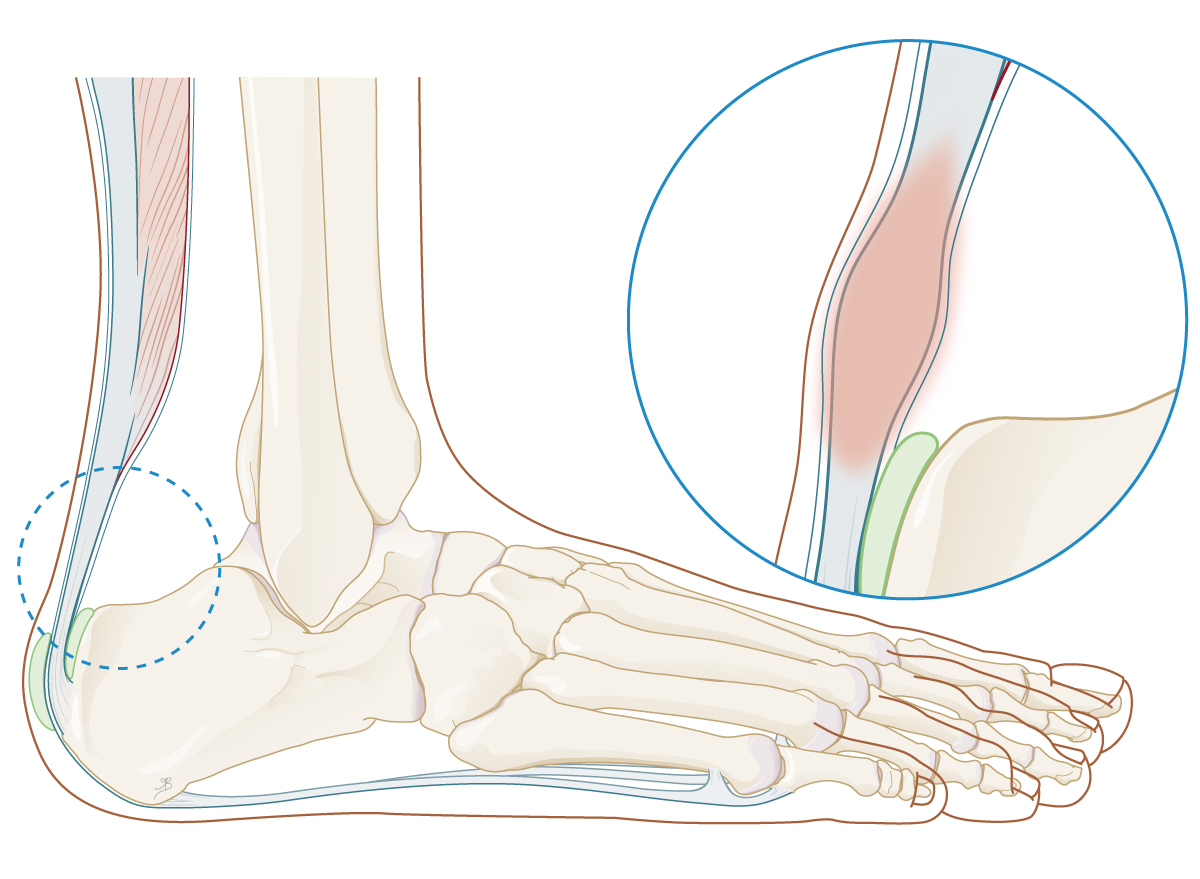 Pijnlijke achillespees - Voetvak+