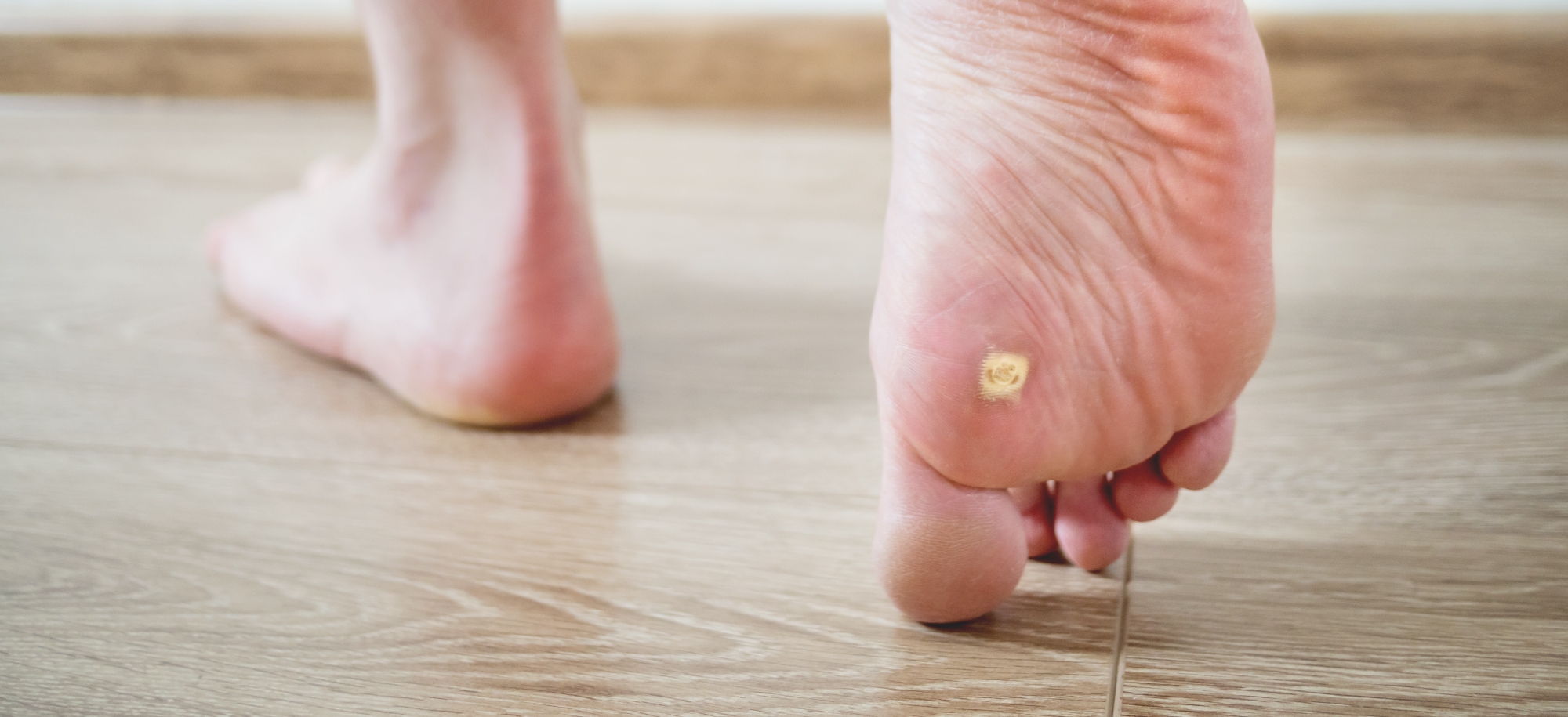 Voetwratten behandelen met duct tape - Voetvak+